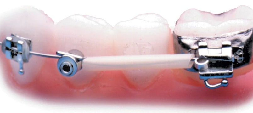 Archwire Sleeve/Tissue Guard 5 Meters - DTC USA – Gogomed Supplies